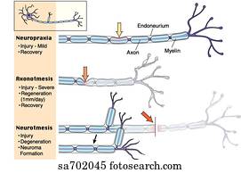 Nerve injury type 2: axonotmesis. Stock Illustration | sa702047 ...
