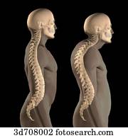Kyphosis (right) vs. normal spinal column (left). Stock Illustration ...