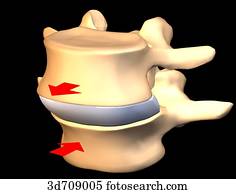 Spondylolisthesis is the forward slippage of lumbar vertebrae. Stock ...