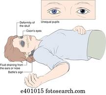 Signs of head injury, head trauma Stock Illustration | e401016 | Fotosearch
