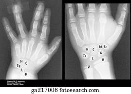 Radius & ulna Stock Illustration | h102064 | Fotosearch