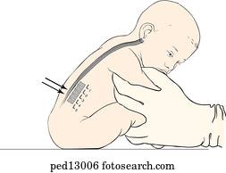 Drawings of Lumbar puncture. gd205004 - Search Clip Art Illustrations ...