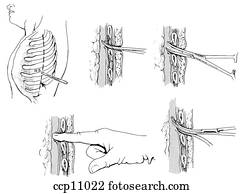 Clipart of Chest tube ccp11021 - Search Clip Art, Illustration Murals ...