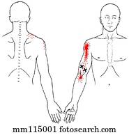 Triceps brachii m., trigger points Stock Illustration | mm115007 ...