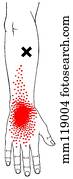 Flexor digitorum brevis m., trigger points Stock Illustration ...