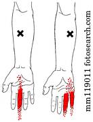 Brachioradialis m., trigger points Drawing | mm115003 | Fotosearch