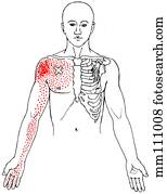 Pectoralis major m., trigger points Stock Illustration | mm111005 ...