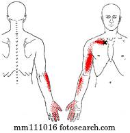 Masseter m., trigger points Drawing | mm106003 | Fotosearch