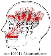 Pectineus m., trigger points Stock Illustration | mm209008 | Fotosearch