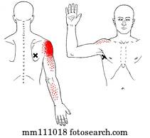 Brachioradialis m., trigger points Drawing | mm115003 | Fotosearch