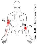 Pectineus m., trigger points Stock Illustration | mm209008 | Fotosearch