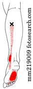 Flexor digitorum m., trigger points Clip Art | mm119011 | Fotosearch