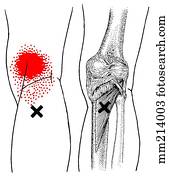 Splenius cervicis m., trigger points Clipart | mm106010 | Fotosearch