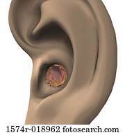 Ear Wax Stock Illustration | Our Top 27 Ear Wax Images | Fotosearch
