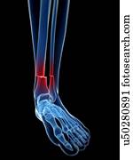 Broken Leg Drawing | pgi0042 | Fotosearch