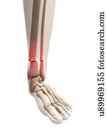 Broken Leg Drawing | pgi0042 | Fotosearch